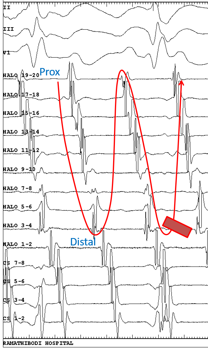 Ablation of AFL/AT: Main Page