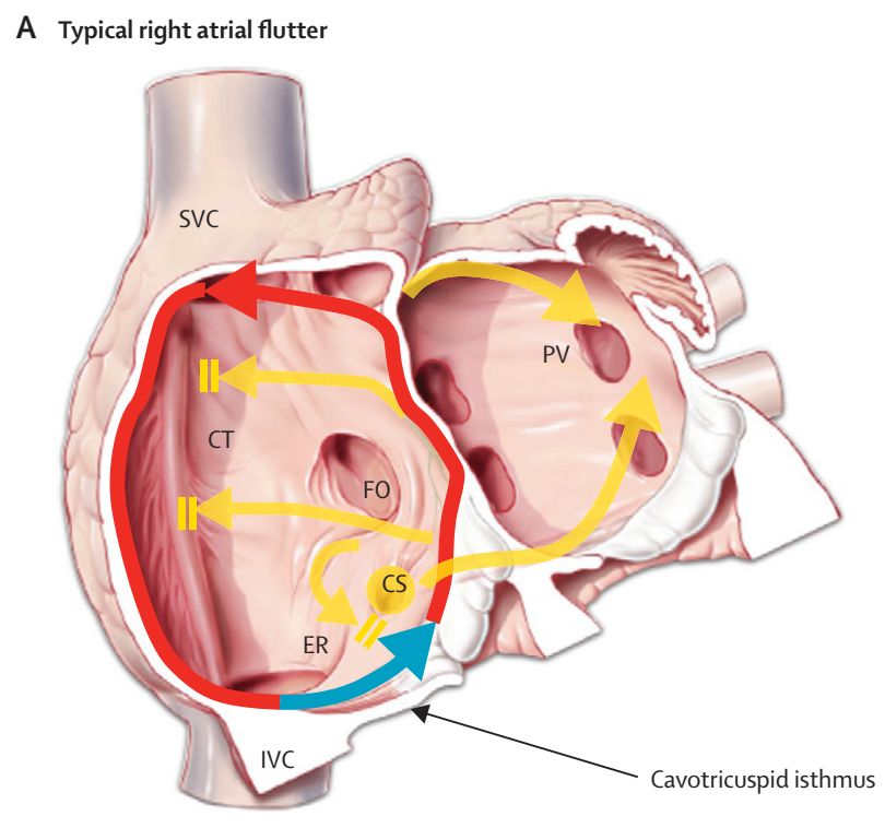 Ablation of AFL/AT: Main Page
