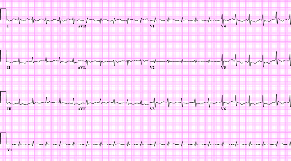 Ablation of AFL/AT: Main Page
